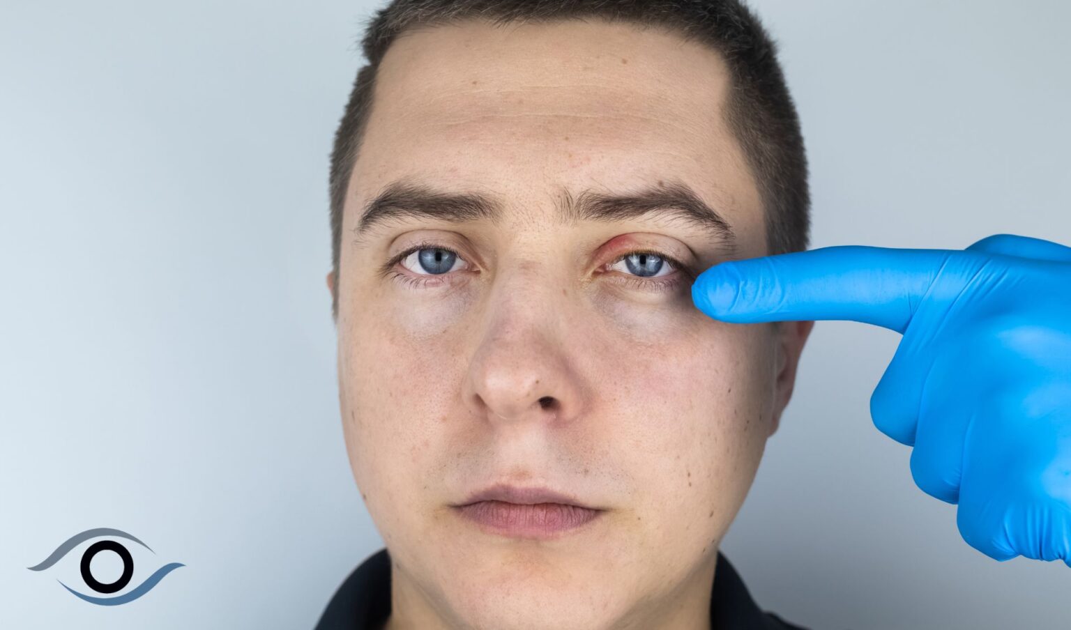 Blepharitis – Hesla Optometry