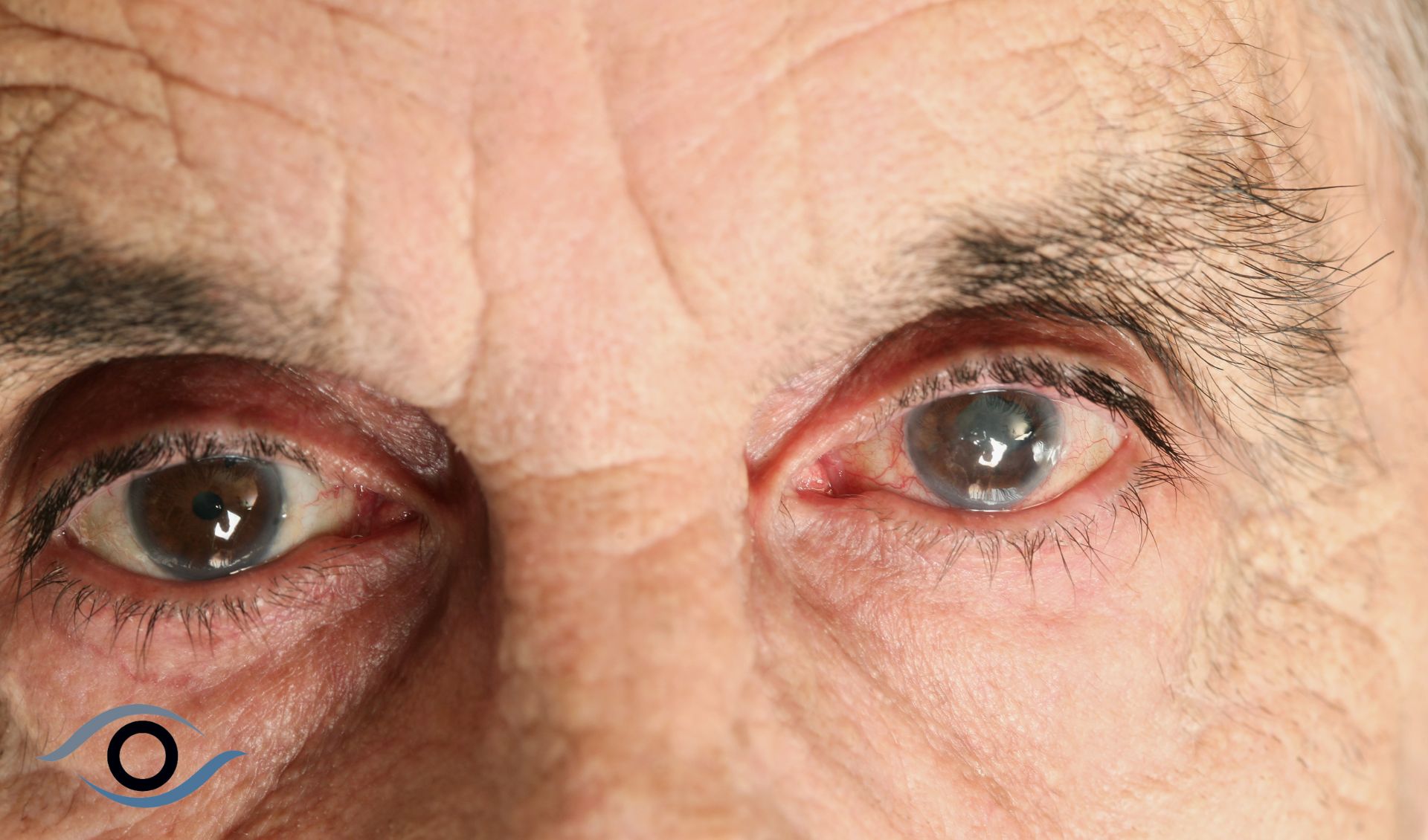 Glaucoma Screening – Hesla Optometry